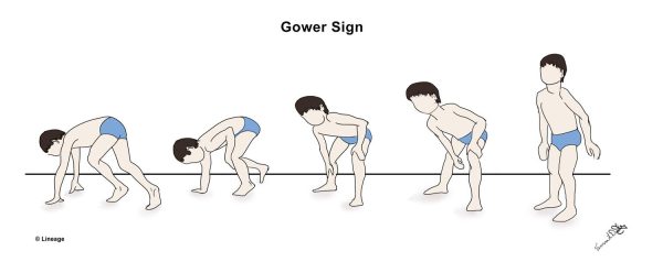 Top 5 Facts About Gower's Sign: How To Easily Demonstrate Gower's Sign ...